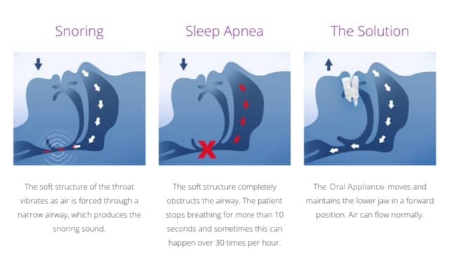 Snoring Waking You Up In The Middle Of The Night? | Stuart FL Stop Snoring